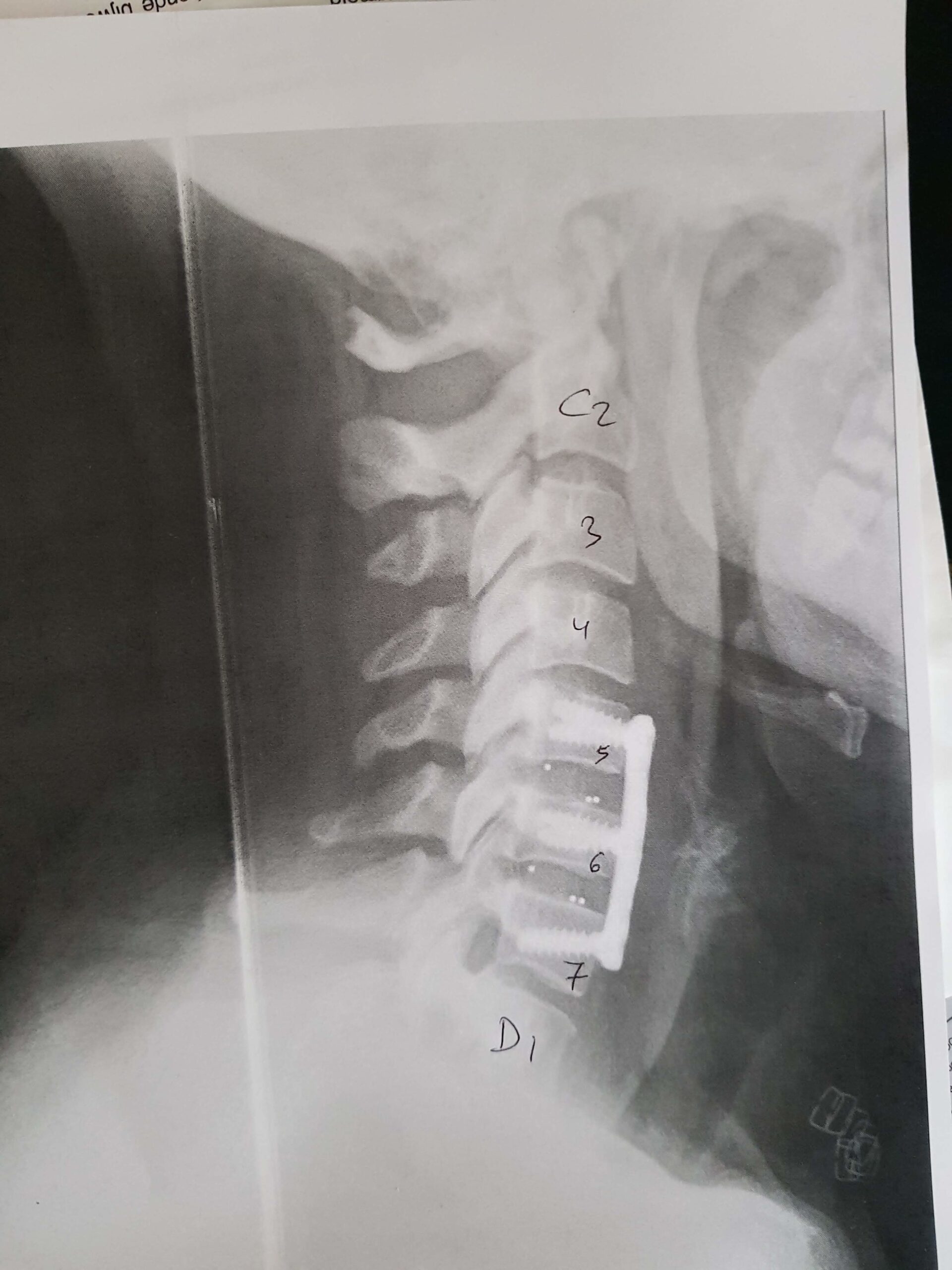 2 nekhernia & een operatie verder, hoe is nu na 3 weken? - Kseen